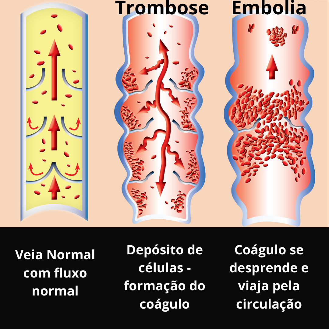Trombose x Covid - 19 | Clínica Dr. Ronaldo Daudt